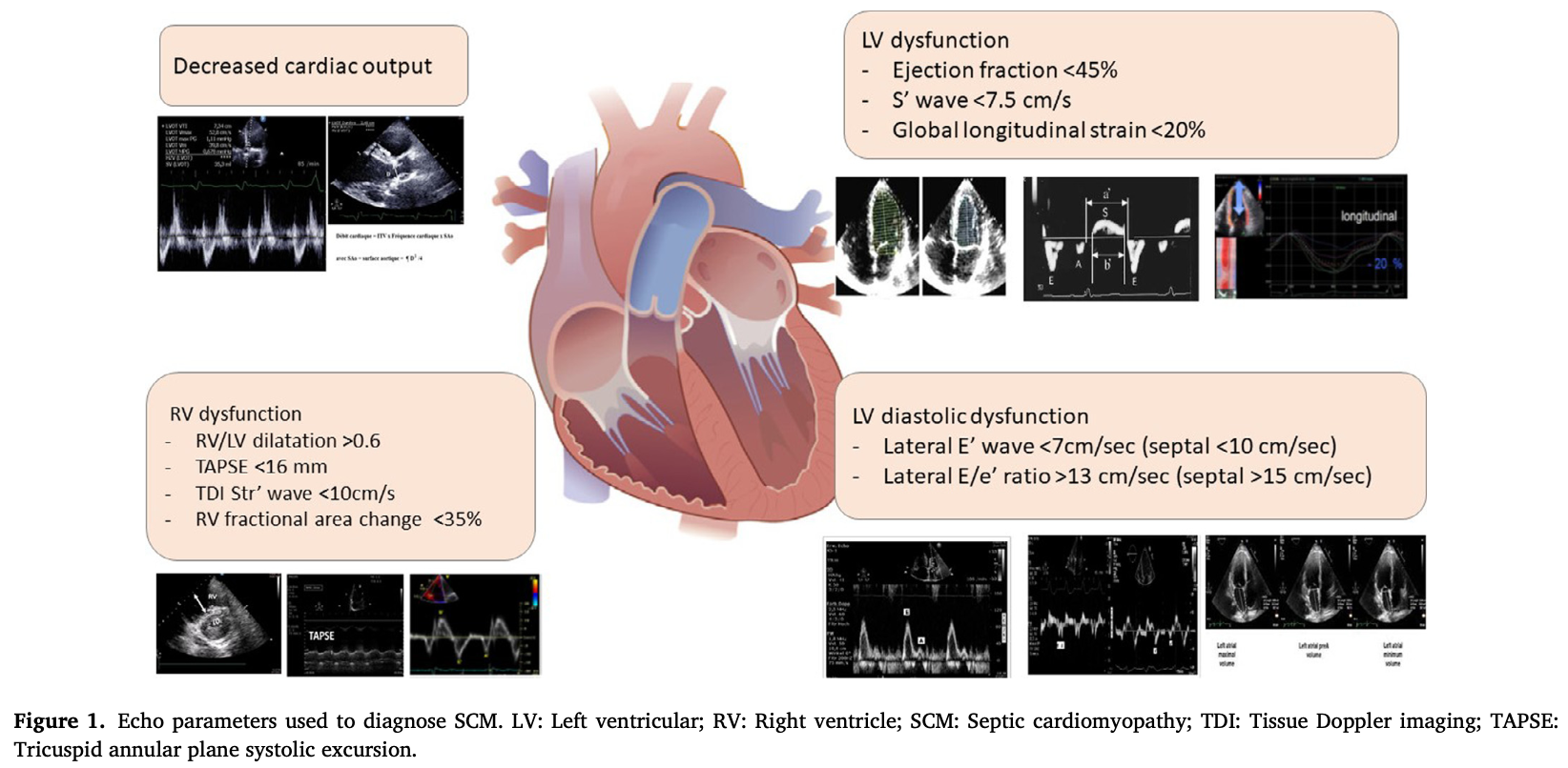 敗血症性心筋症（SCM：Septic cardiomyopathy） – Dr.Gajumaruのメディカルワークアウト